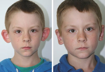 Ear Correction - Dr Zurek